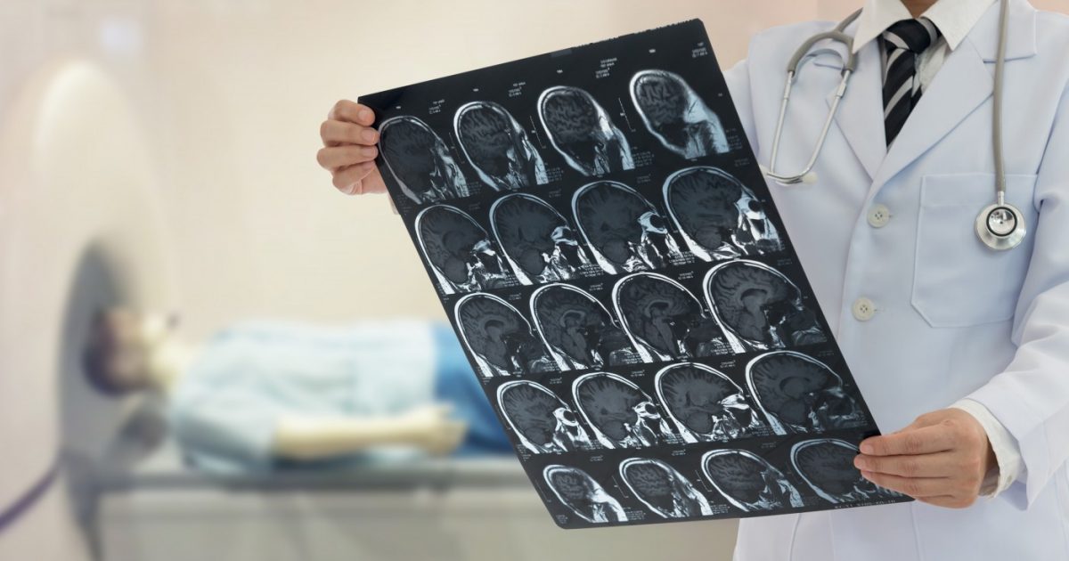 Bulbar-Onset ALS Patients Found to Have Extensive Brain Tissue Loss